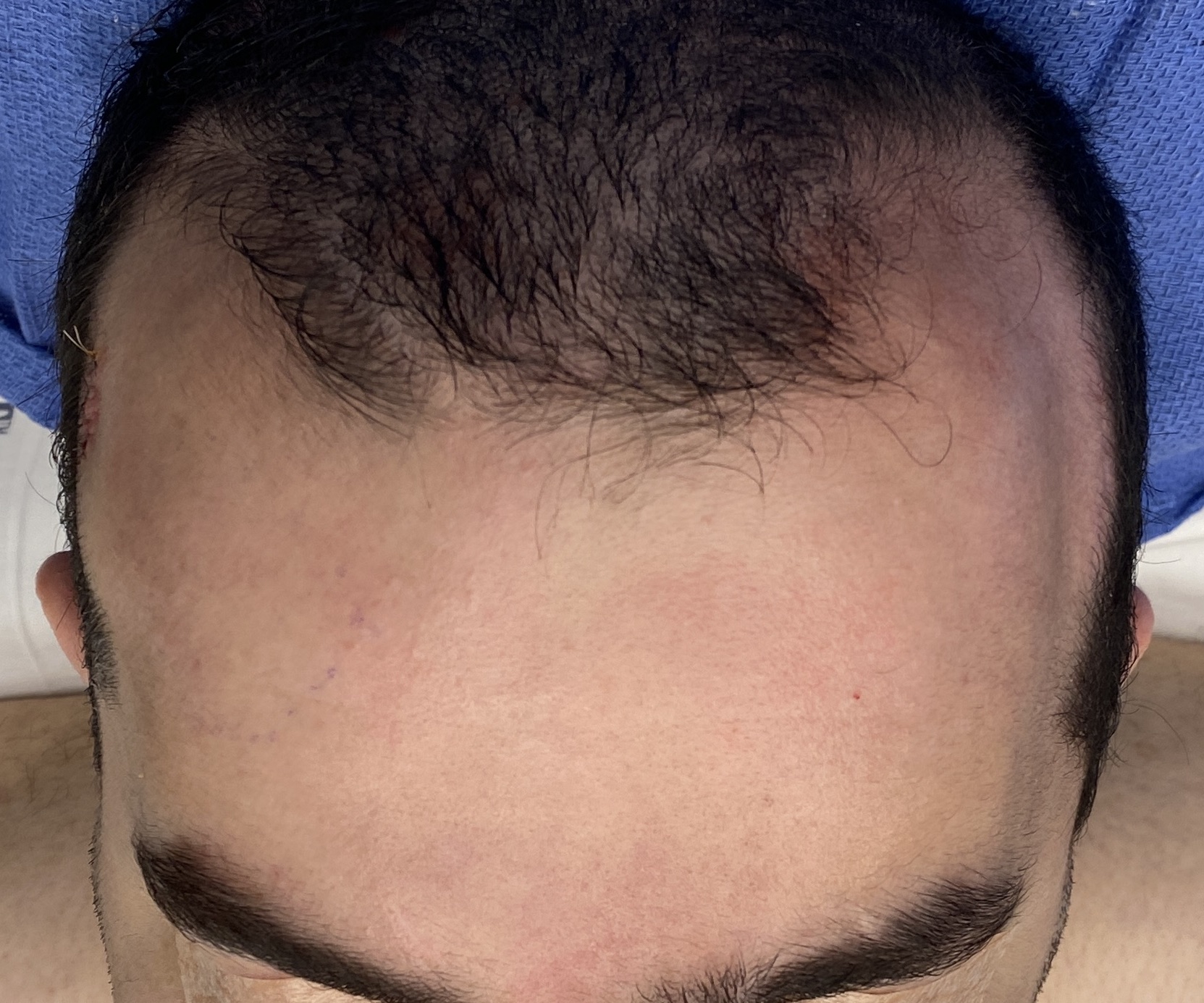Plastic Surgery Case Study - Temporal Hairline Incision for Bony ...