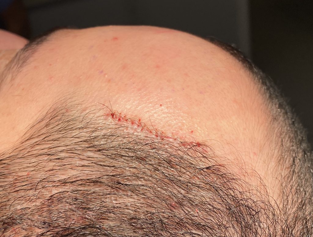 Plastic Surgery Case Study - Temporal Hairline Incision for Bony ...