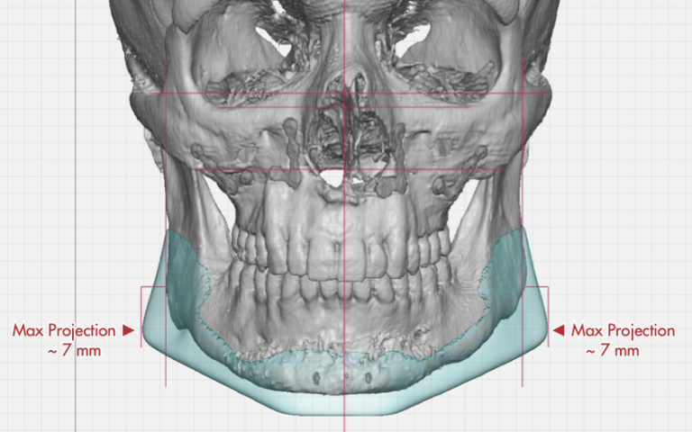 Plastic Surgery Case Study - Custom Jawline Implant for 3D Vertical ...