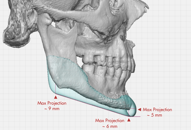 male custom jawline implant measurements side view Dr Barry Eppley ...