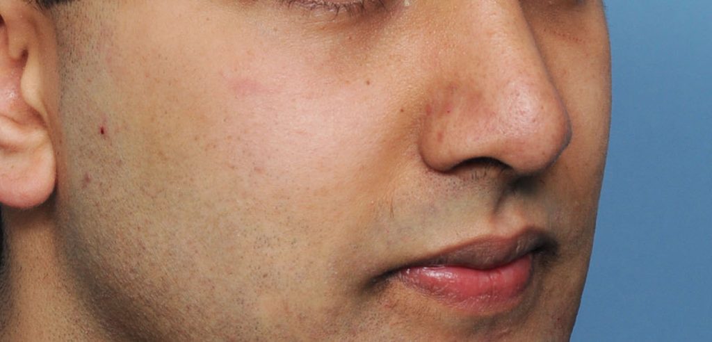 Plastic Surgery Case Study - Achieving A Non-Osteotomy Midface ...