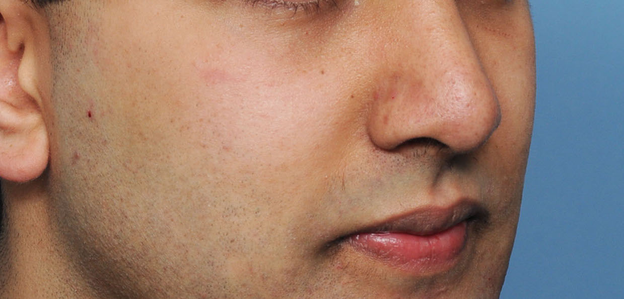 Plastic Surgery Case Study - Achieving A Non-Osteotomy Midface ...