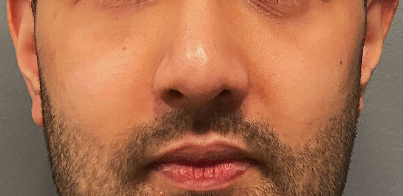 Plastic Surgery Case Study - Achieving A Non-Osteotomy Midface ...