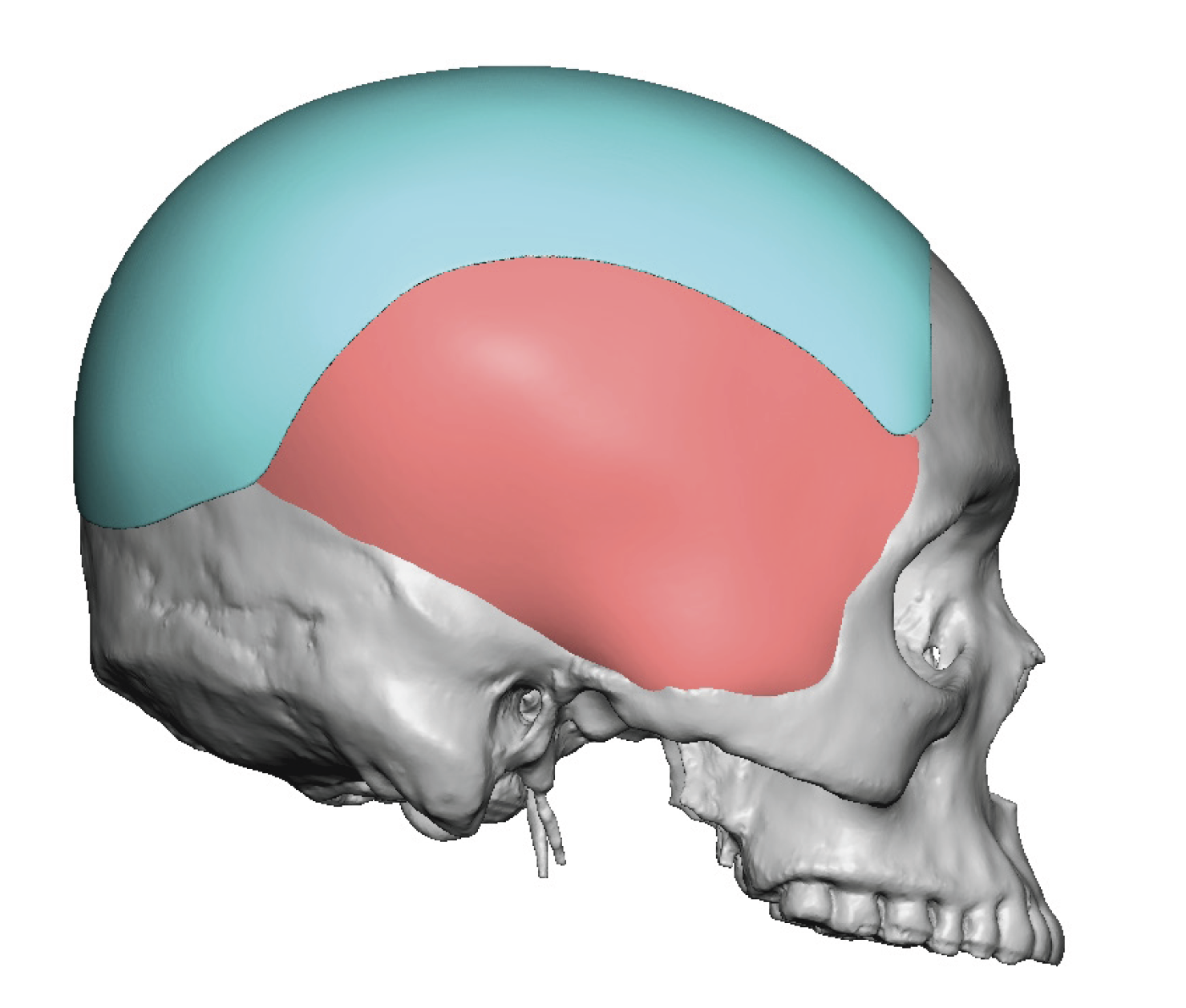Plastic Surgery Case Study - Custom Skull Implant for Reshaping the ...