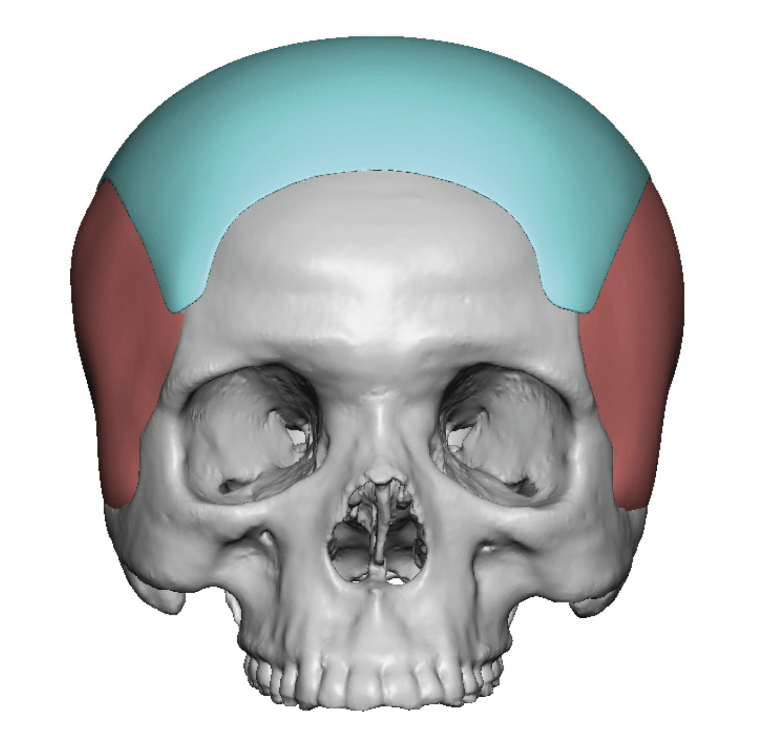 Plastic Surgery Case Study - Custom Skull Implant for Reshaping the ...