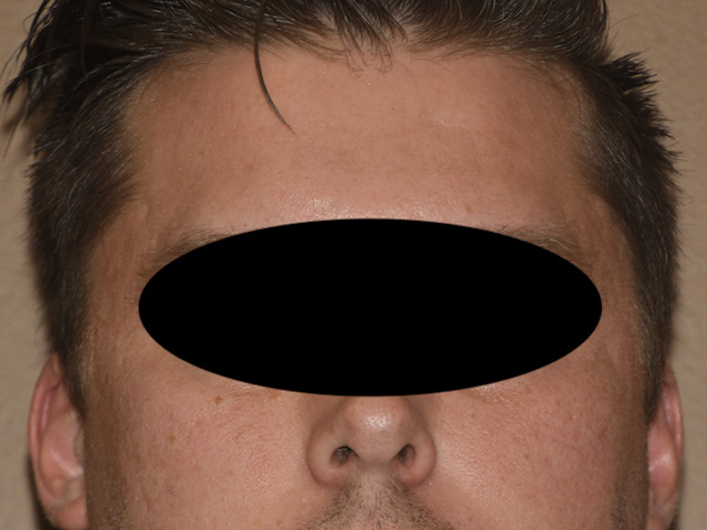 Plastic Surgery Case Study - Male Custom Temporal Implants for Forehead ...