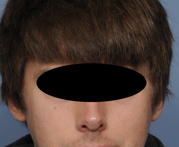 Plastic Surgery Case Study - Male Custom Temporal Implants for Forehead ...