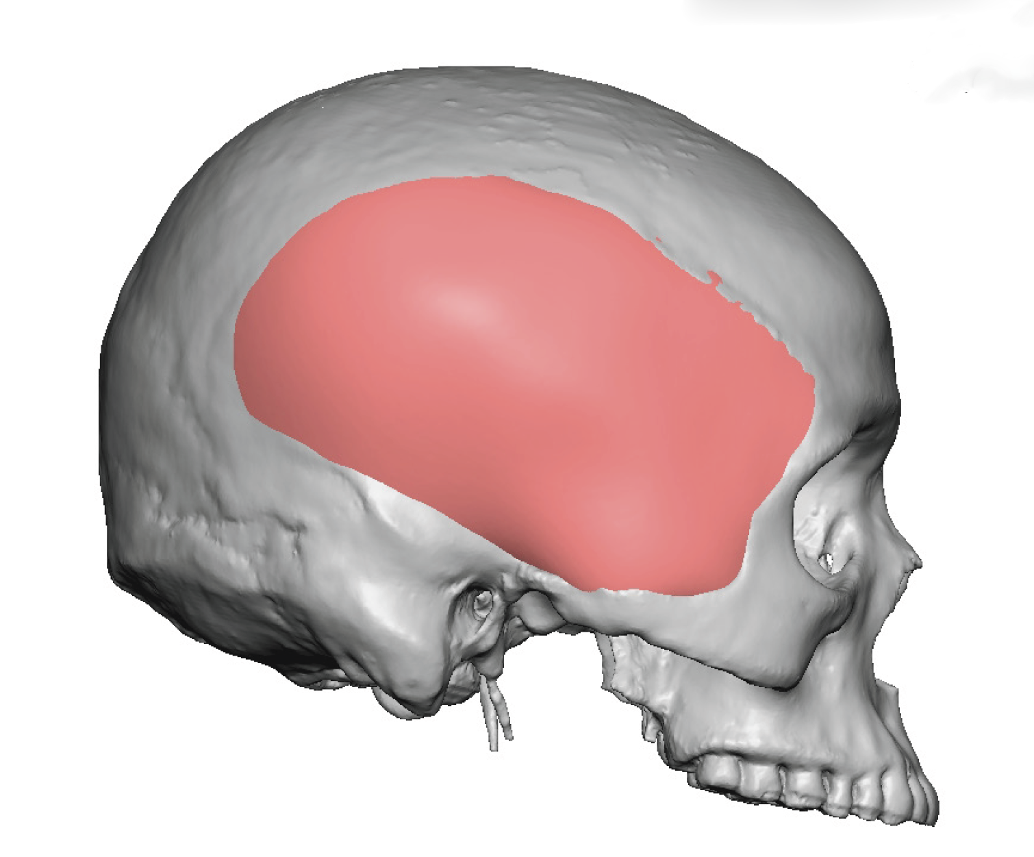 Plastic Surgery Case Study - Custom Skull Implant for Reshaping the ...