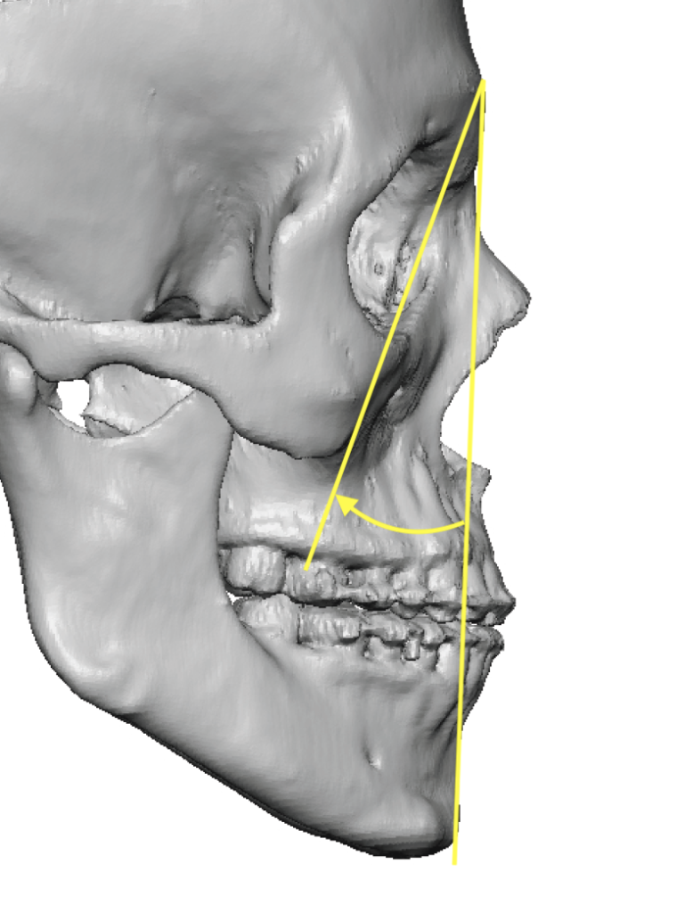 male infraorbital-malar deficiency 3D CT scan side view Dr Barry Eppley ...