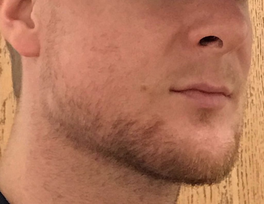 Plastic Surgery Case Study - Custom Jawline Implant for 3D Vertical ...