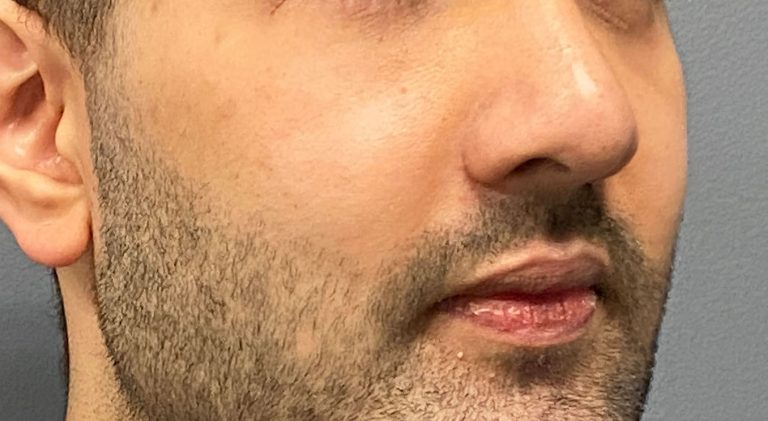 Plastic Surgery Case Study - Achieving A Non-Osteotomy Midface ...