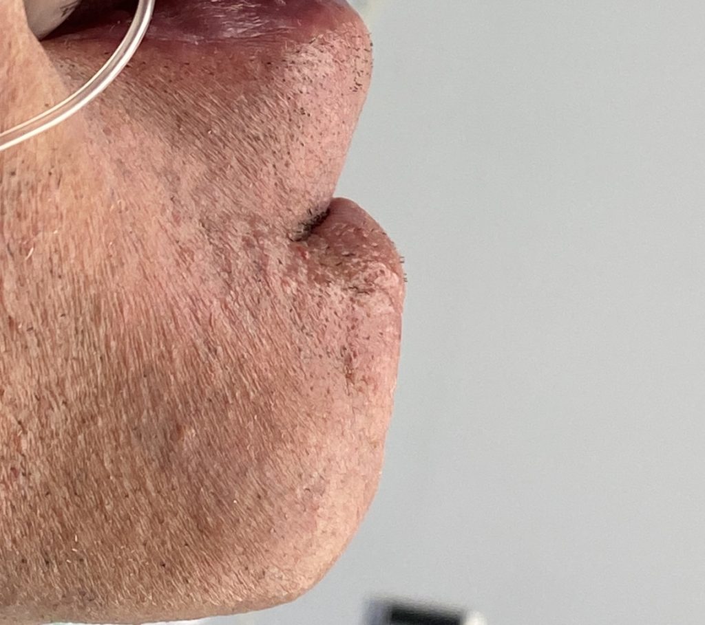 Plastic Surgery Case Study - Male Transcutaneous Soft Tissue Chin Pad ...