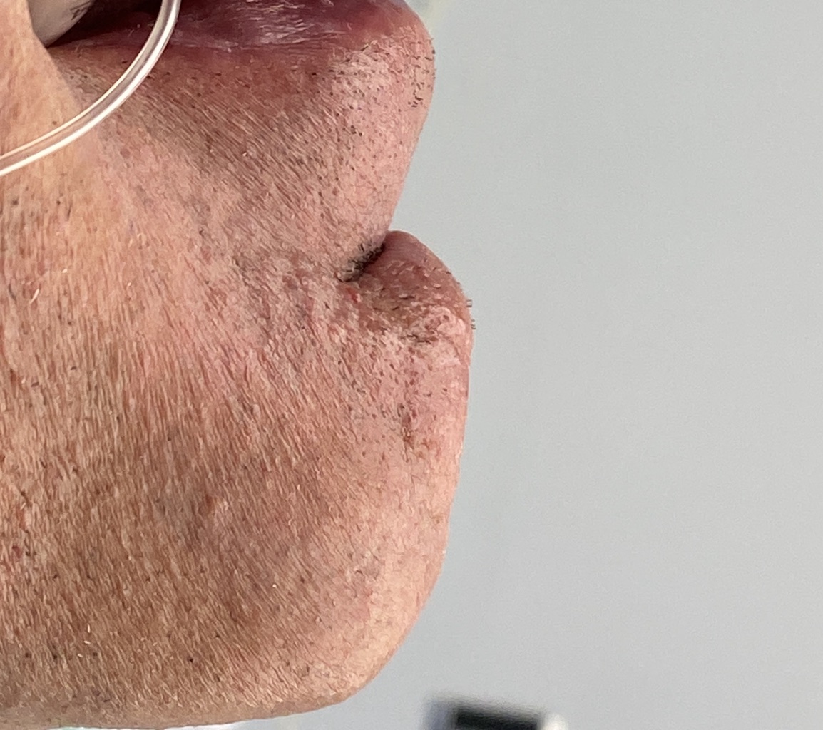 Plastic Surgery Case Study - Male Transcutaneous Soft Tissue Chin Pad ...