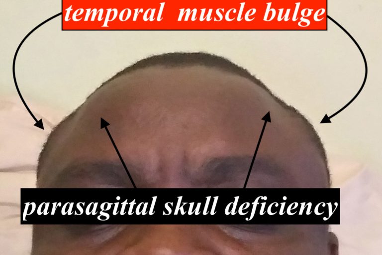 male skull deformity front view Dr Barry Eppley - Explore Plastic Surgery