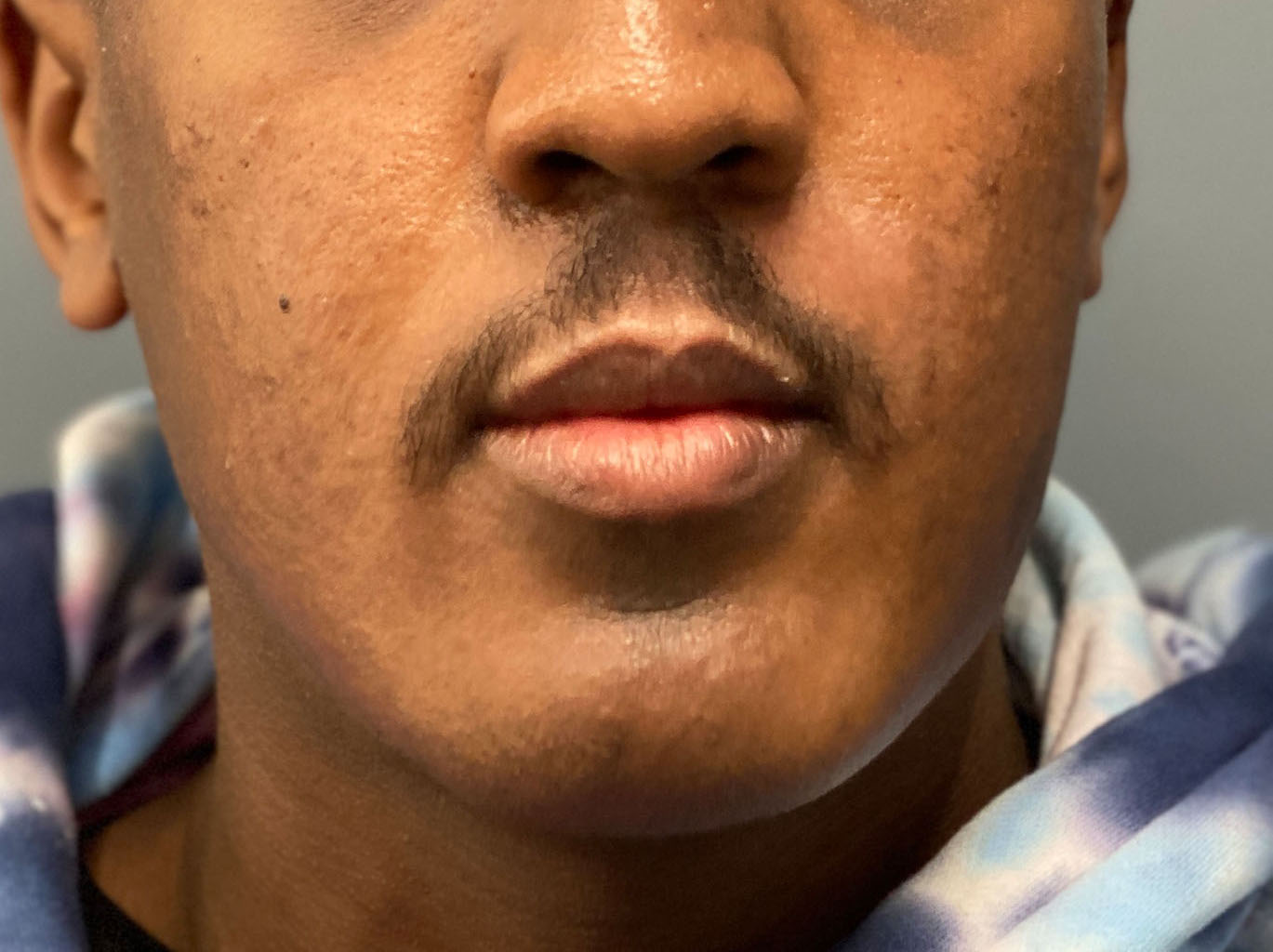 Plastic Surgery Case Study - A Combined Autologous - Alloplastic Method ...