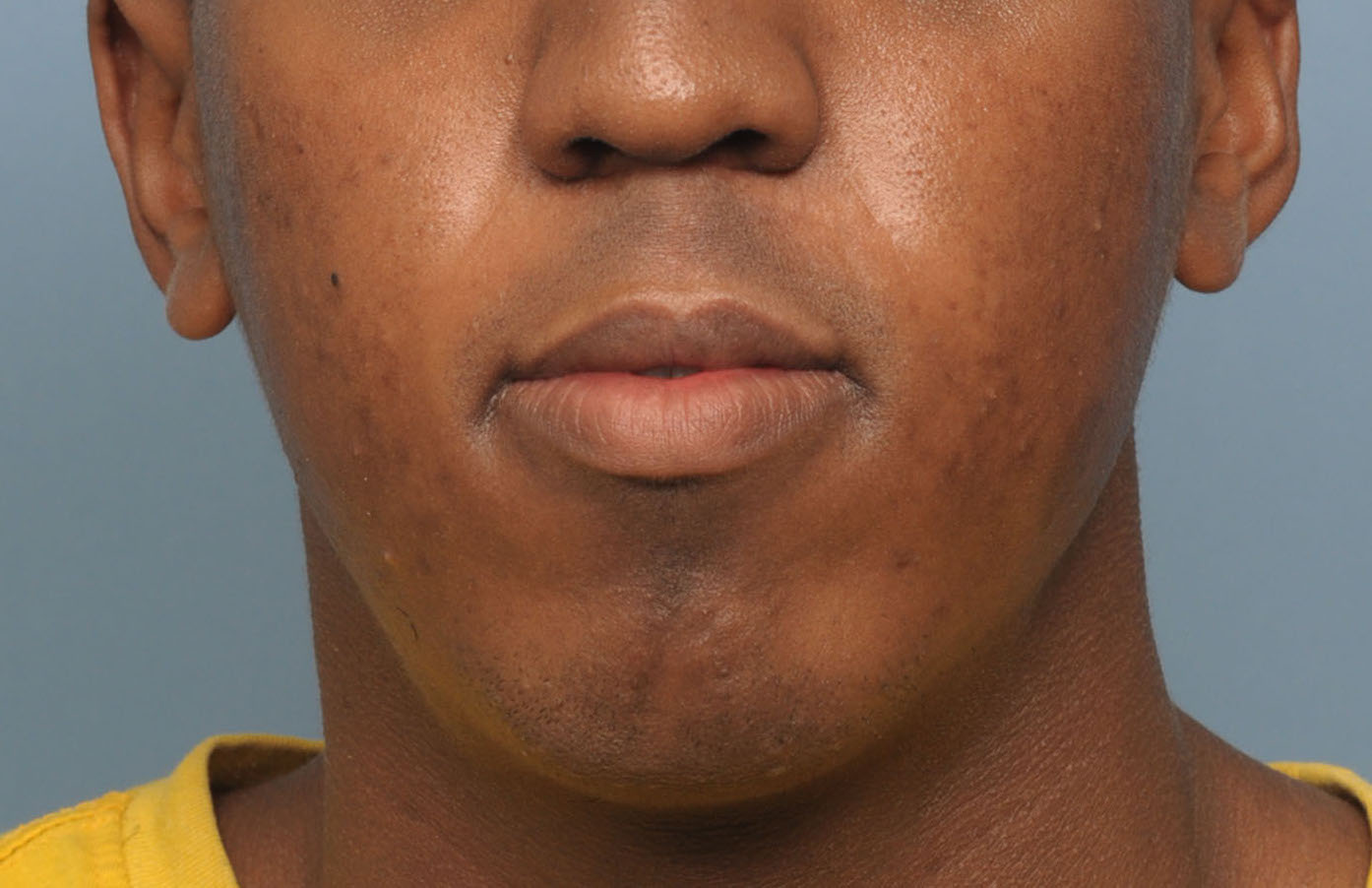 Plastic Surgery Case Study - A Combined Autologous - Alloplastic Method ...