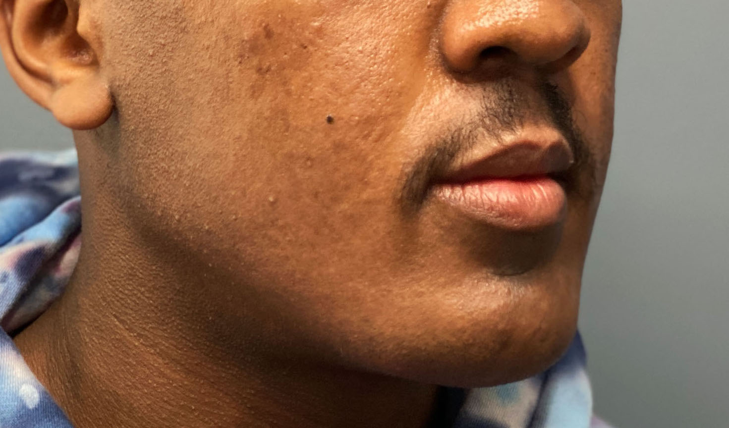 Plastic Surgery Case Study - A Combined Autologous - Alloplastic Method ...