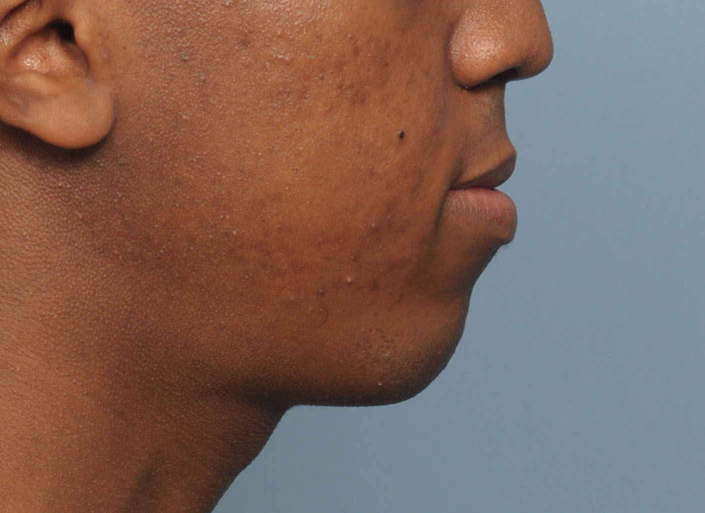 Plastic Surgery Case Study - A Combined Autologous - Alloplastic Method ...