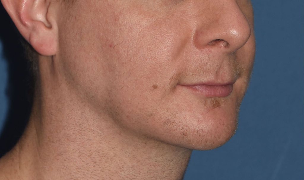 Plastic Surgery Case Study - Custom Jawline Implant for 3D Vertical ...