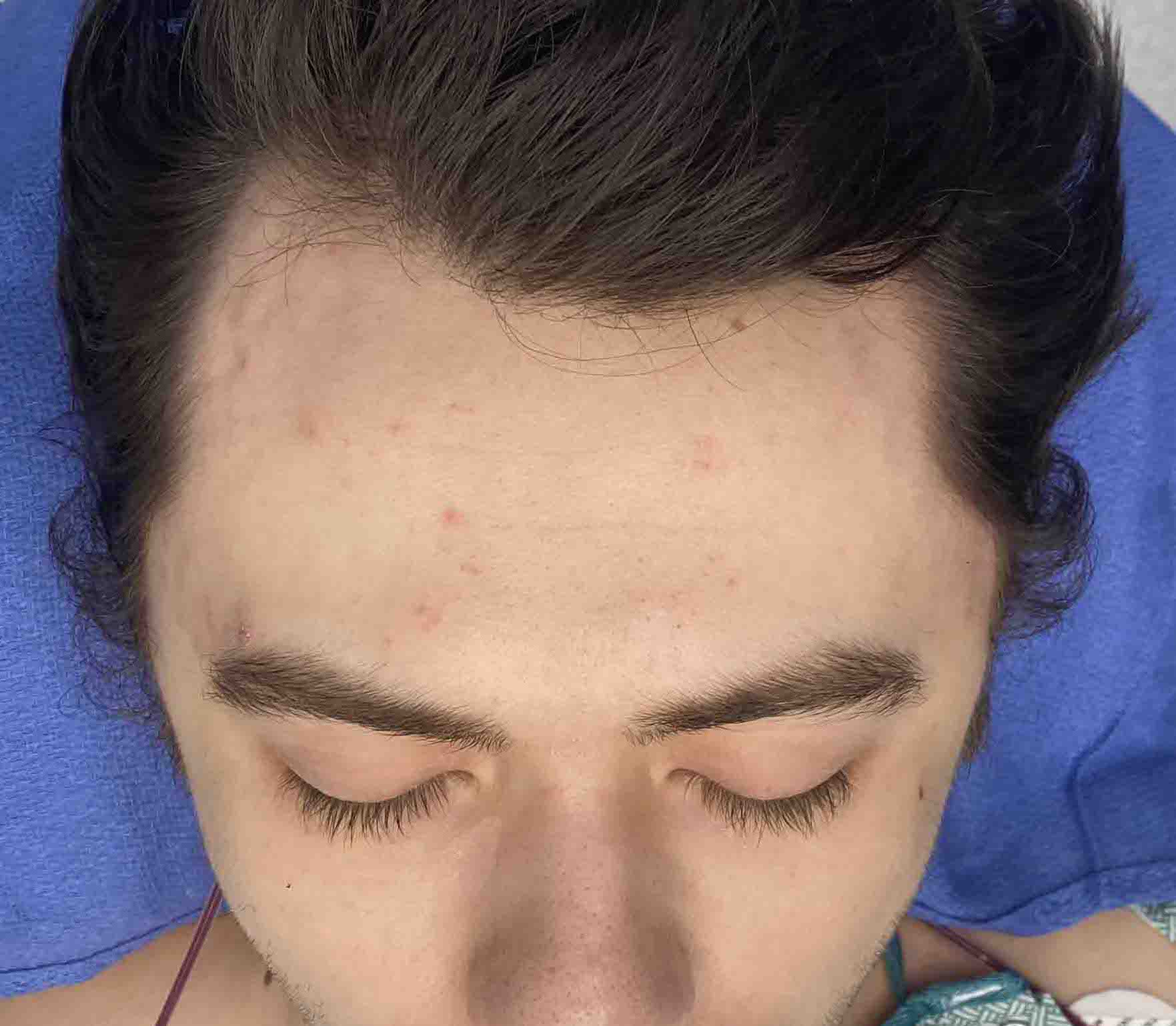 The Outcomes Of Temporal Reduction Surgery For Head Width Reshaping A