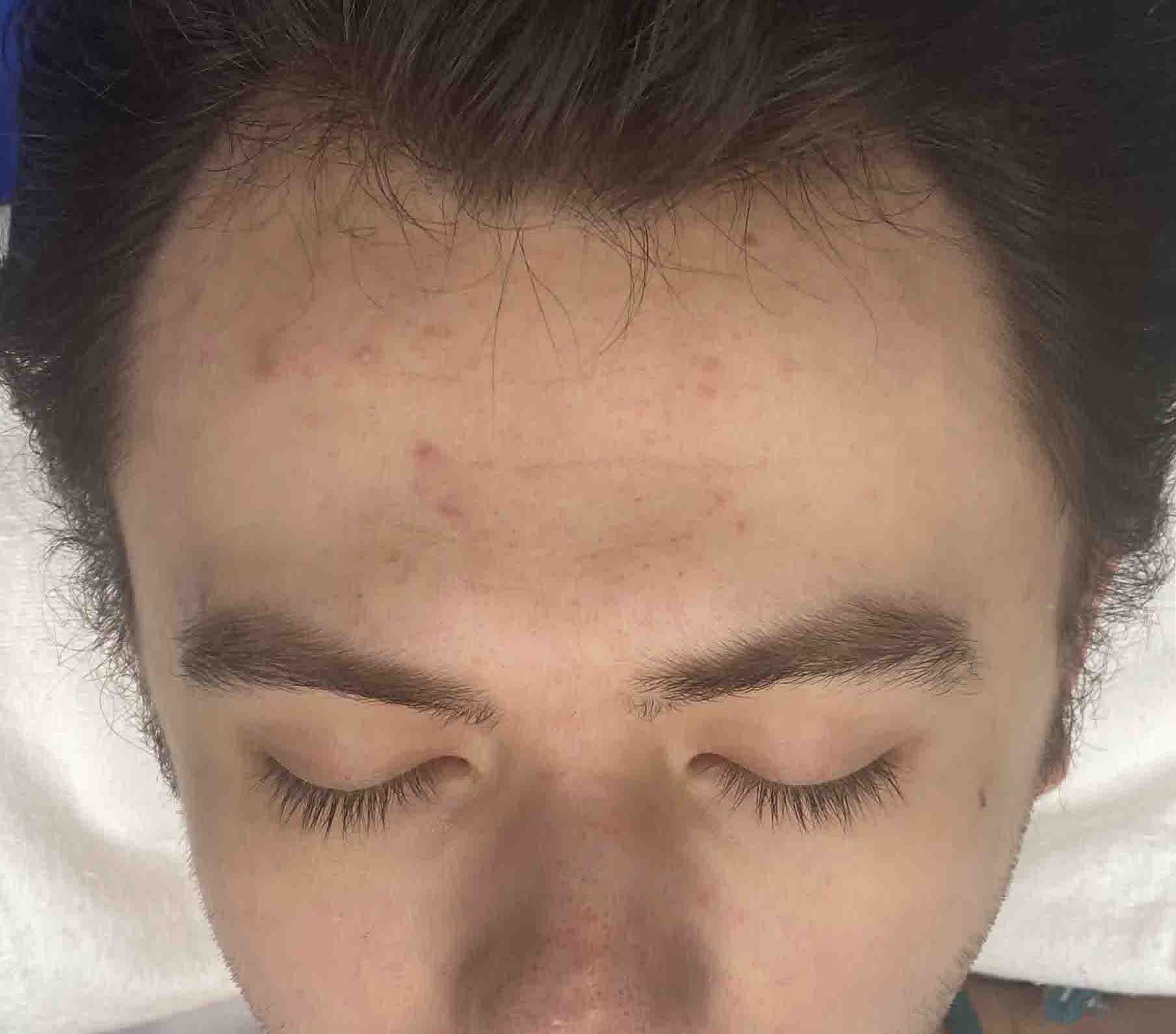 The Outcomes of Temporal Reduction Surgery for Head Width Reshaping - A ...