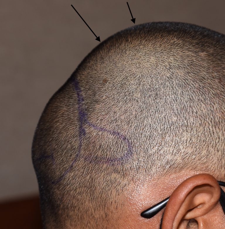 Plastic Surgery Case Study Bone Dust Grafting Of Skull Indentations