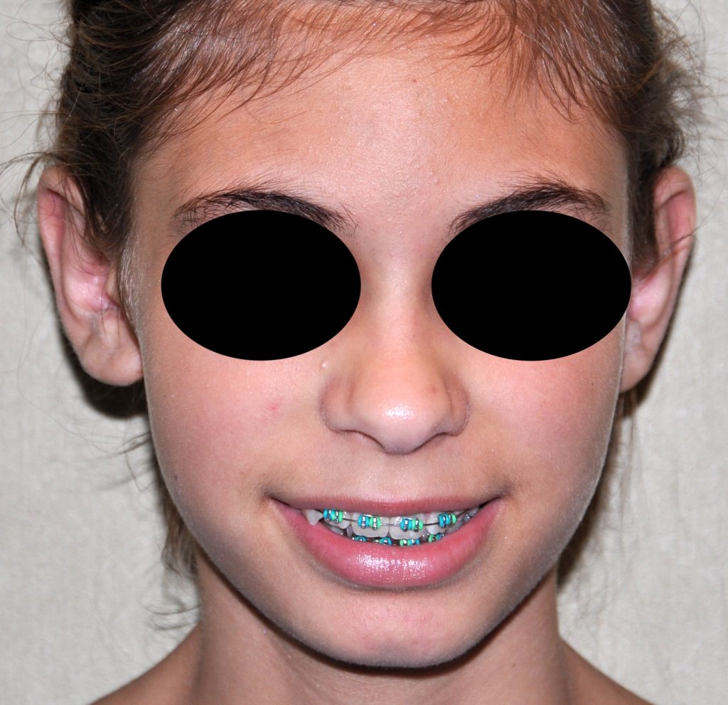 Plastic Surgery Case Study - Long-Term Suture Extrusion in Setback ...