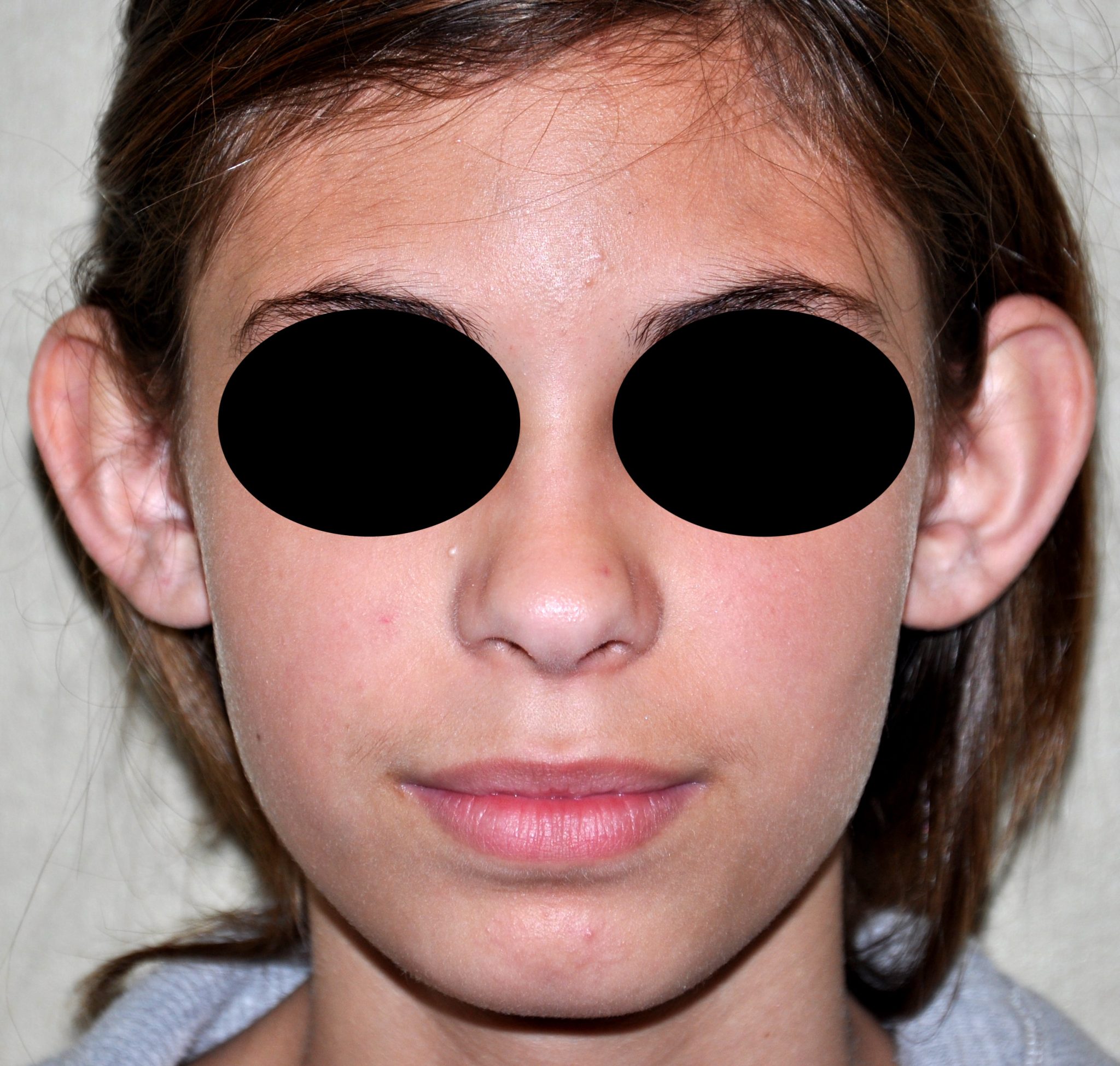 Plastic Surgery Case Study - Long-Term Suture Extrusion in Setback ...