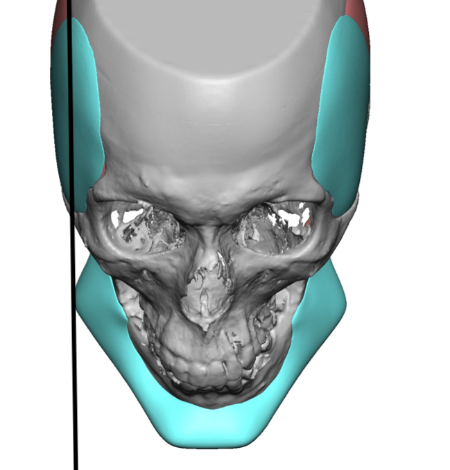 Plastic Surgery Case Study - Male Custom Temporal Implants for Forehead ... Plastic Surgery Case Study - Male Custom Temporal Implants for Forehead ...