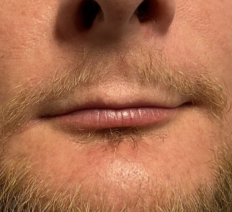 Plastic Surgery Case Study - Lip Advancement in the Very Thin Upper ...