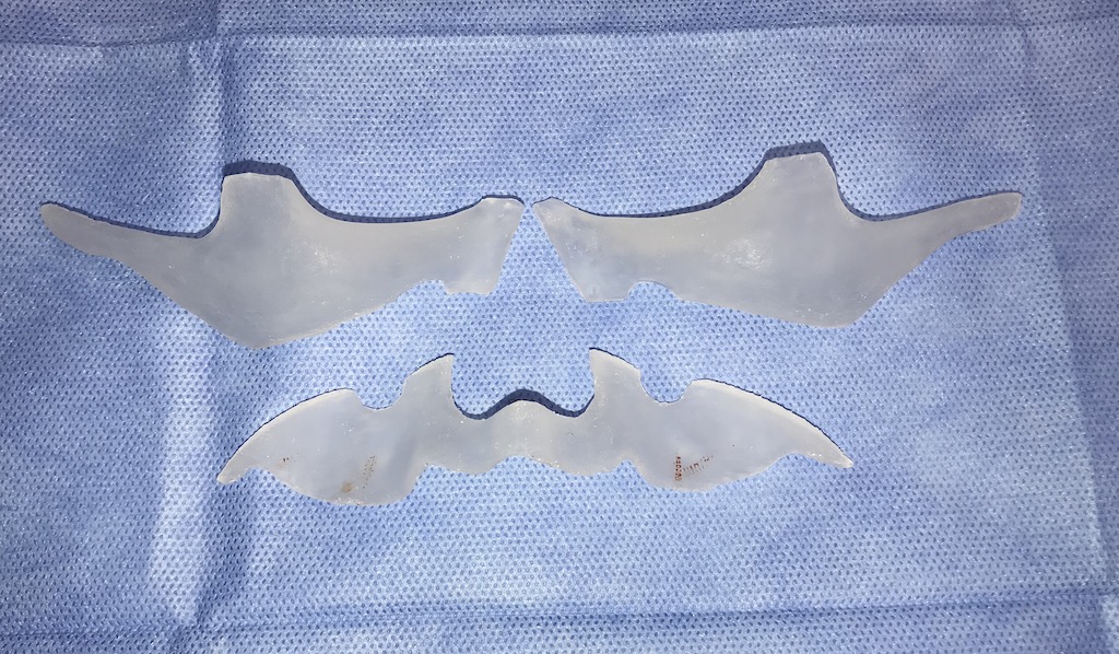 Plastic Surgery Case Study - Achieving A Non-Osteotomy Midface ...