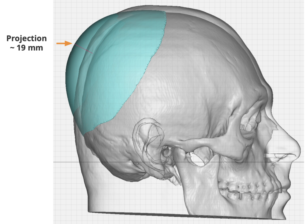Plastic Surgery Case Study - The Unintentional Two Stage Back of Head ...