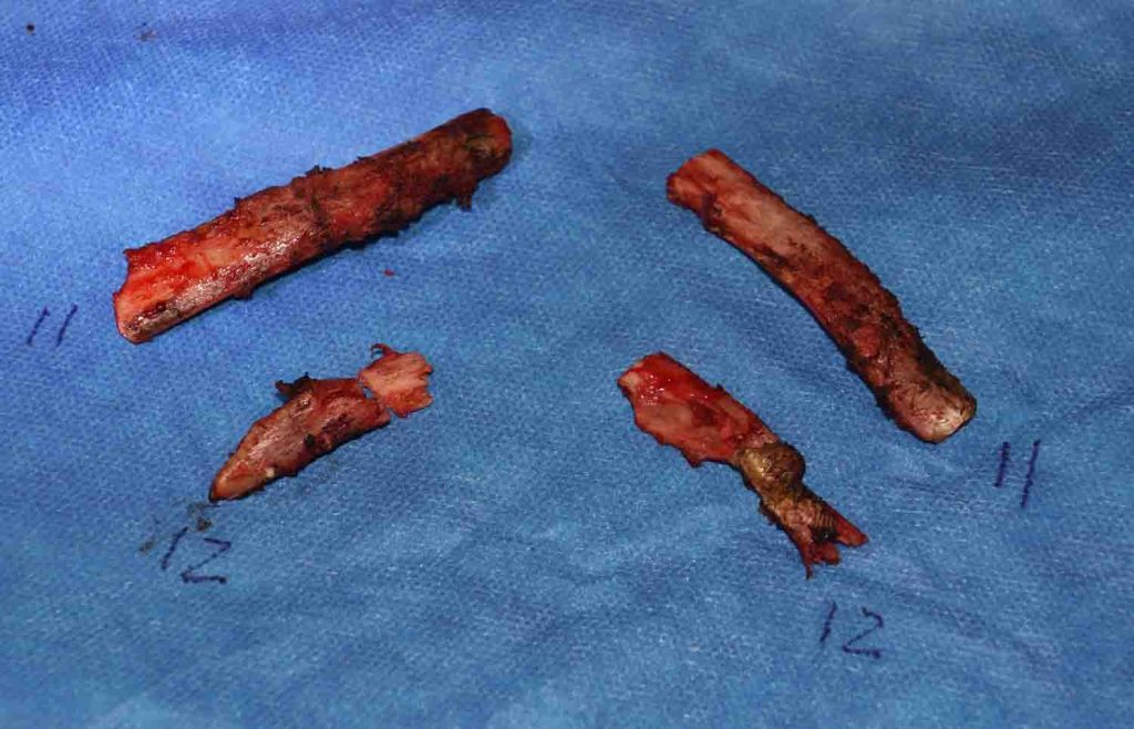 A Quantitative Assessment of Ant Waist Surgery (Free Floating Rib ...