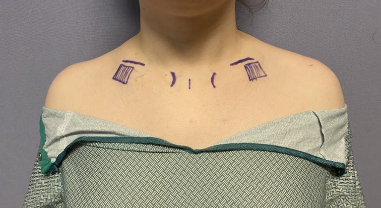 Plastic Surgery Case Study - Shoulder Narrowing Surgery in Highly ...