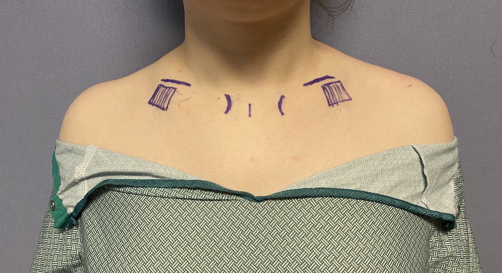 Plastic Surgery Case Study - Shoulder Narrowing Surgery in Highly ...