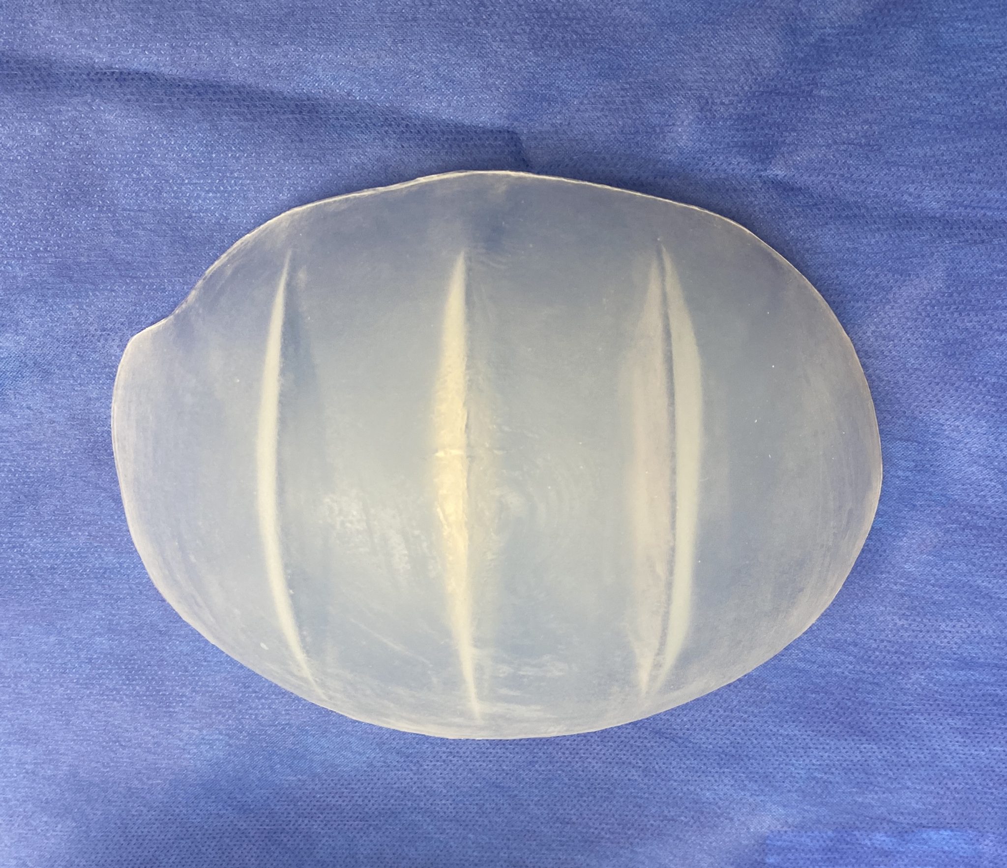 Plastic Surgery Case Study - Increasing the Curvature of the Flat Back ...