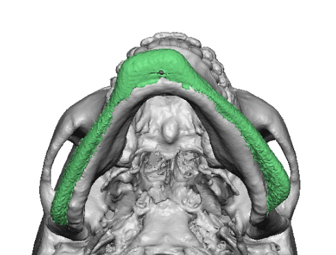 custom jawline implant asymmetry postop 3D CT scan suibmental view Dr ...