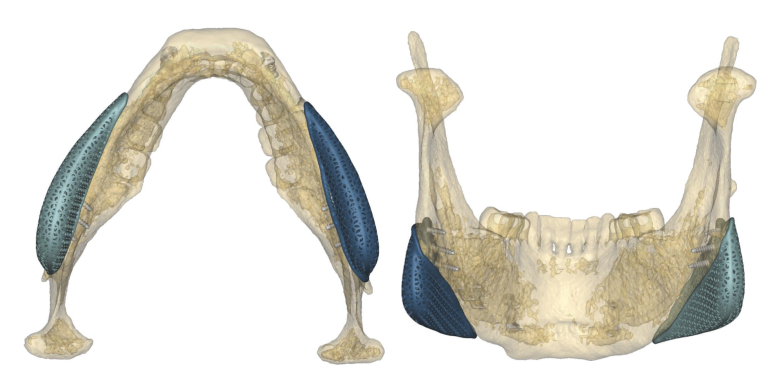 custom titanium jaw angle implants Dr Barry Eppley - Explore Plastic ...