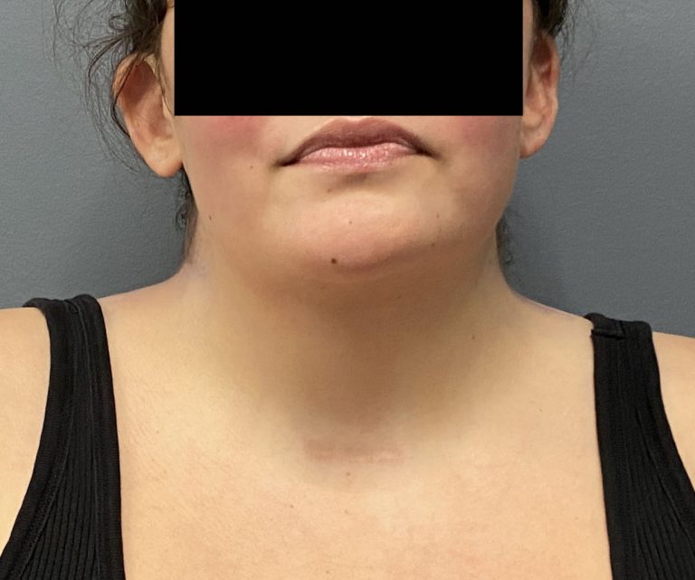 Plastic Surgery Case Study - Webbed Neck Correction with Buffalo Hump ...