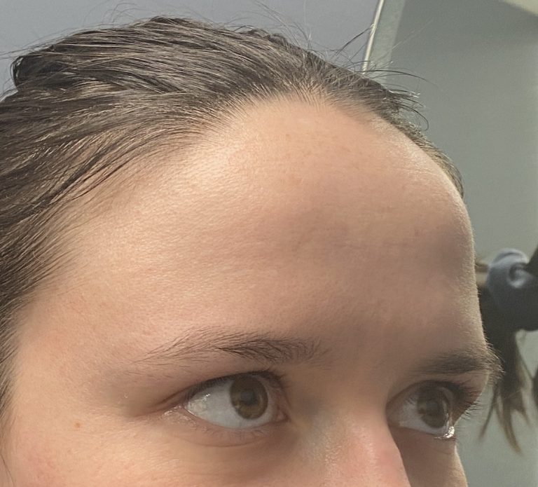 Plastic Surgery Case Study - Female Forehead Feminization with Bony ...