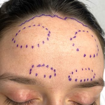 forehead recontouring Archives - Explore Plastic Surgery