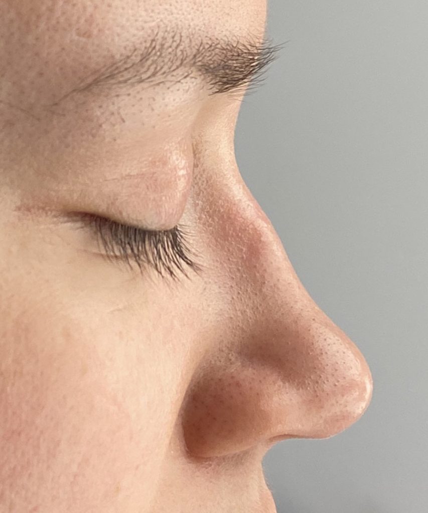 Plastic Surgery Case Study - The Long Nose Rhinoplasty with Tip ...