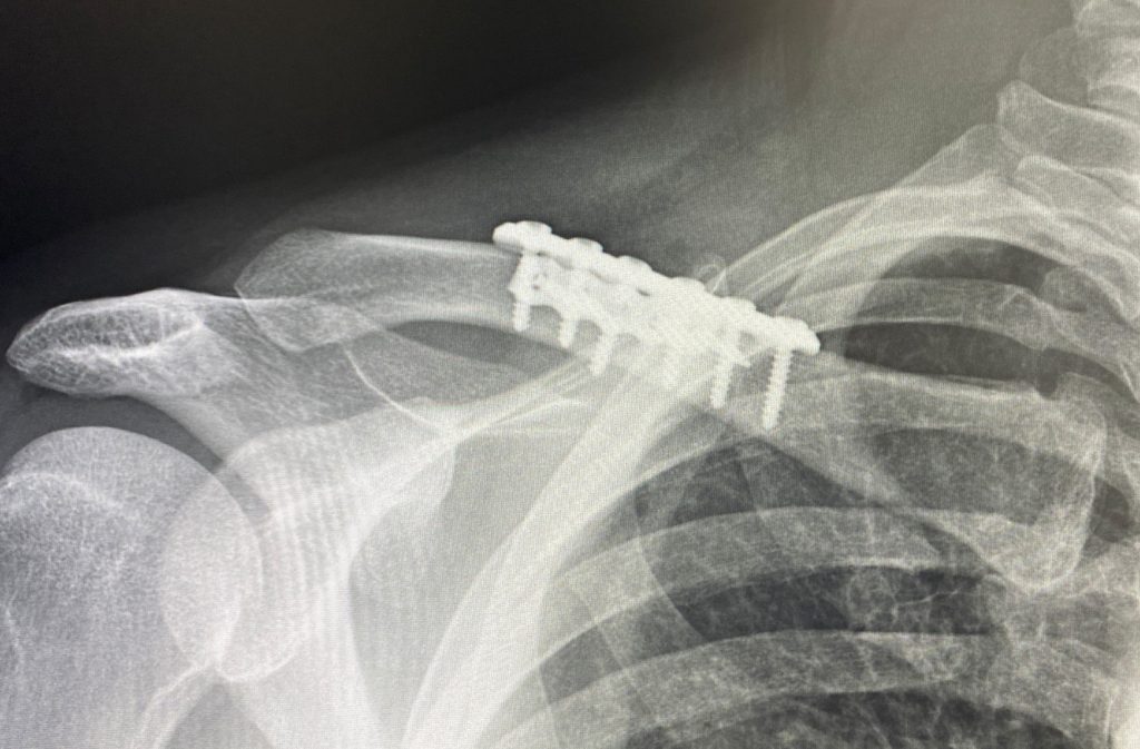 Plastic Surgery Case Study - Clavicle Reduction Osteotomies in the ...