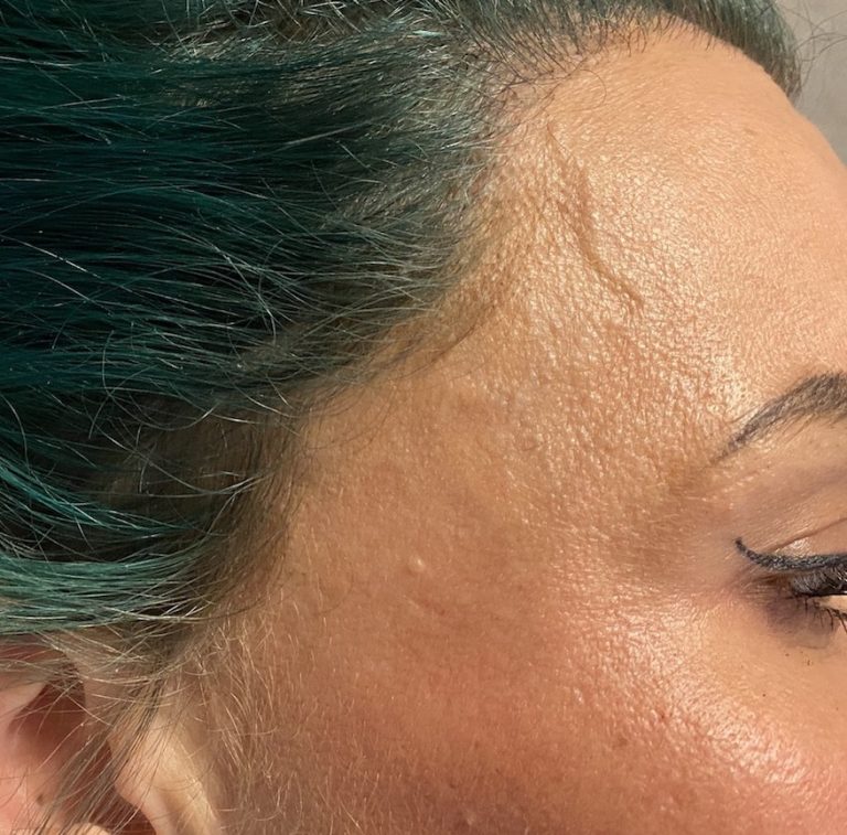 Plastic Surgery Case Study - Reduction of Prominent Female Temporal ...