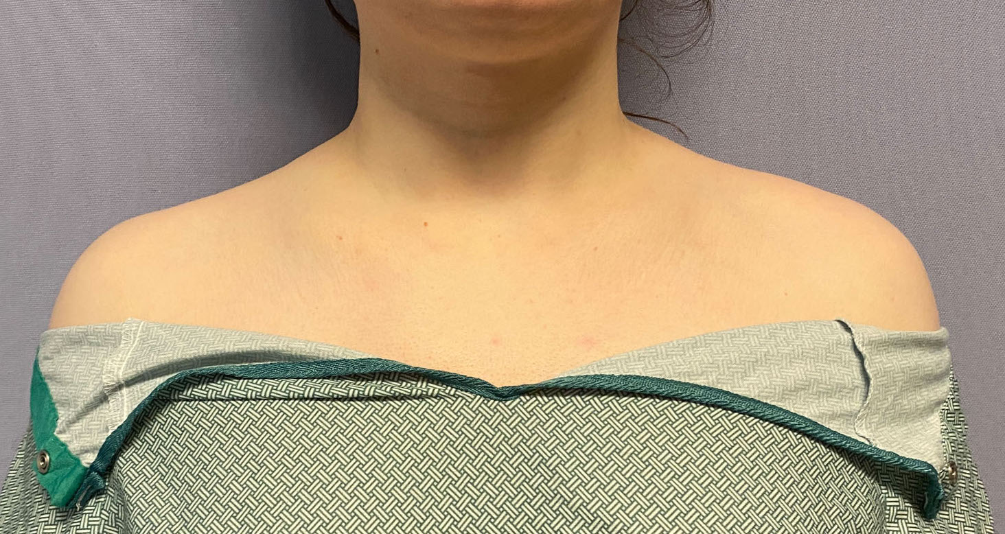 Plastic Surgery Case Study - Shoulder Narrowing Surgery in Highly ...