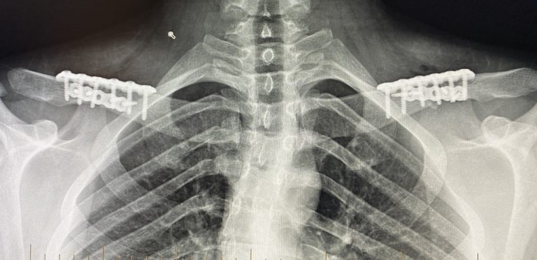 Plastic Surgery Case Study - Shoulder Narrowing Surgery in Highly ...