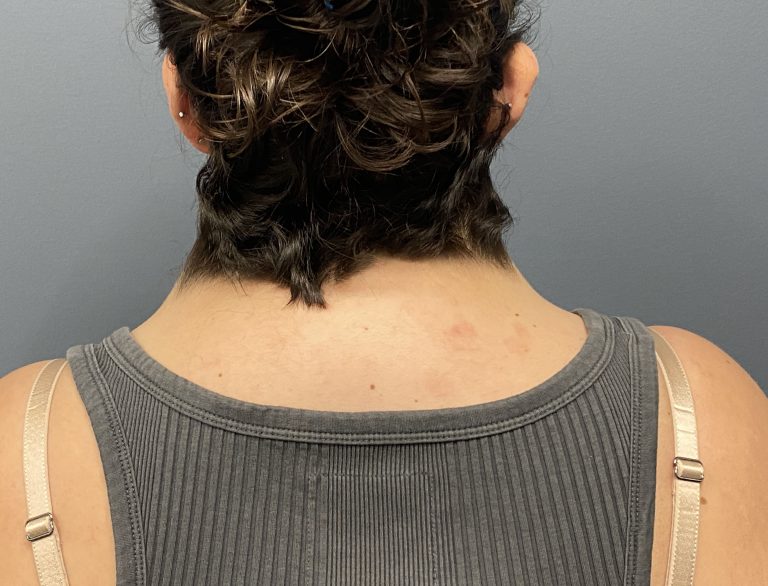 Plastic Surgery Case Study - Webbed Neck Correction with Buffalo Hump ...