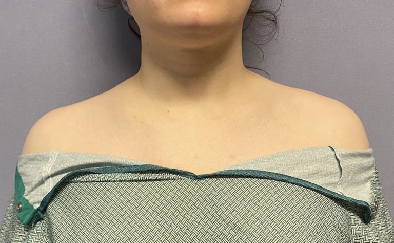 Plastic Surgery Case Study - Shoulder Narrowing Surgery in Highly ...