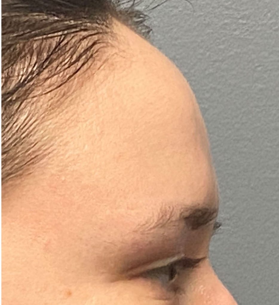 Plastic Surgery Case Study - Female Forehead Feminization with Bony ...