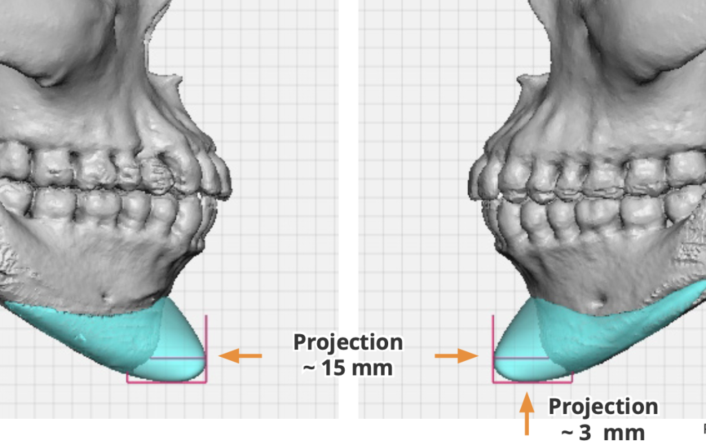 Plastic Surgery Case Study - Custom Chin Implant Replacement of a ...